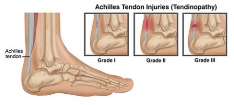 Achilles tendon injury (Tendinopathy) - reactive