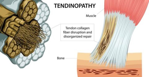 Managing Tendon Pain - reactive